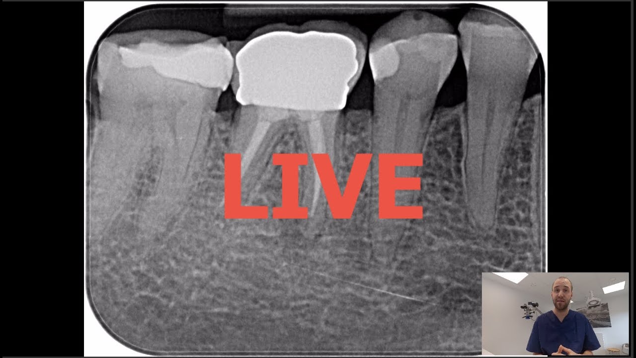Commentaires LIVE - Retraitement endodontique - 46 couronne, tenons ...