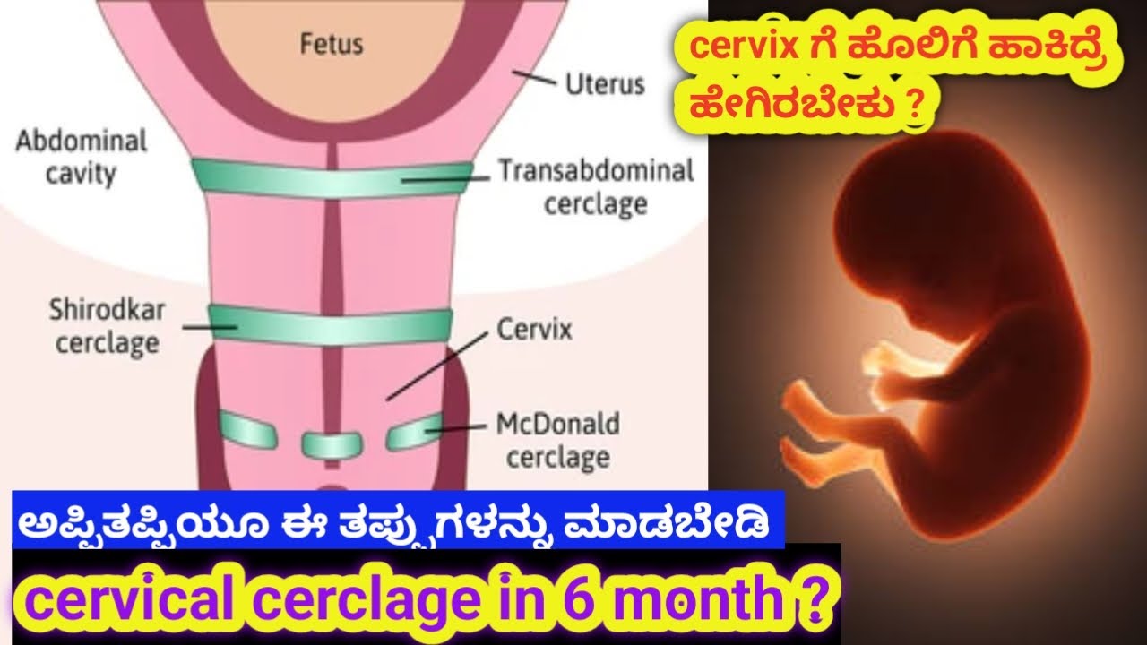 Cervical ಹೊಲಿಗೆ ಹಾಕಿದ್ರೆ ಹೇಗಿರಬೇಕು l cervical cerclage in 6 month ...