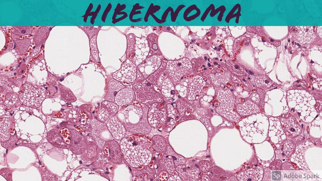 Hibernoma: 5-Minute Pathology Pearls - YouTube