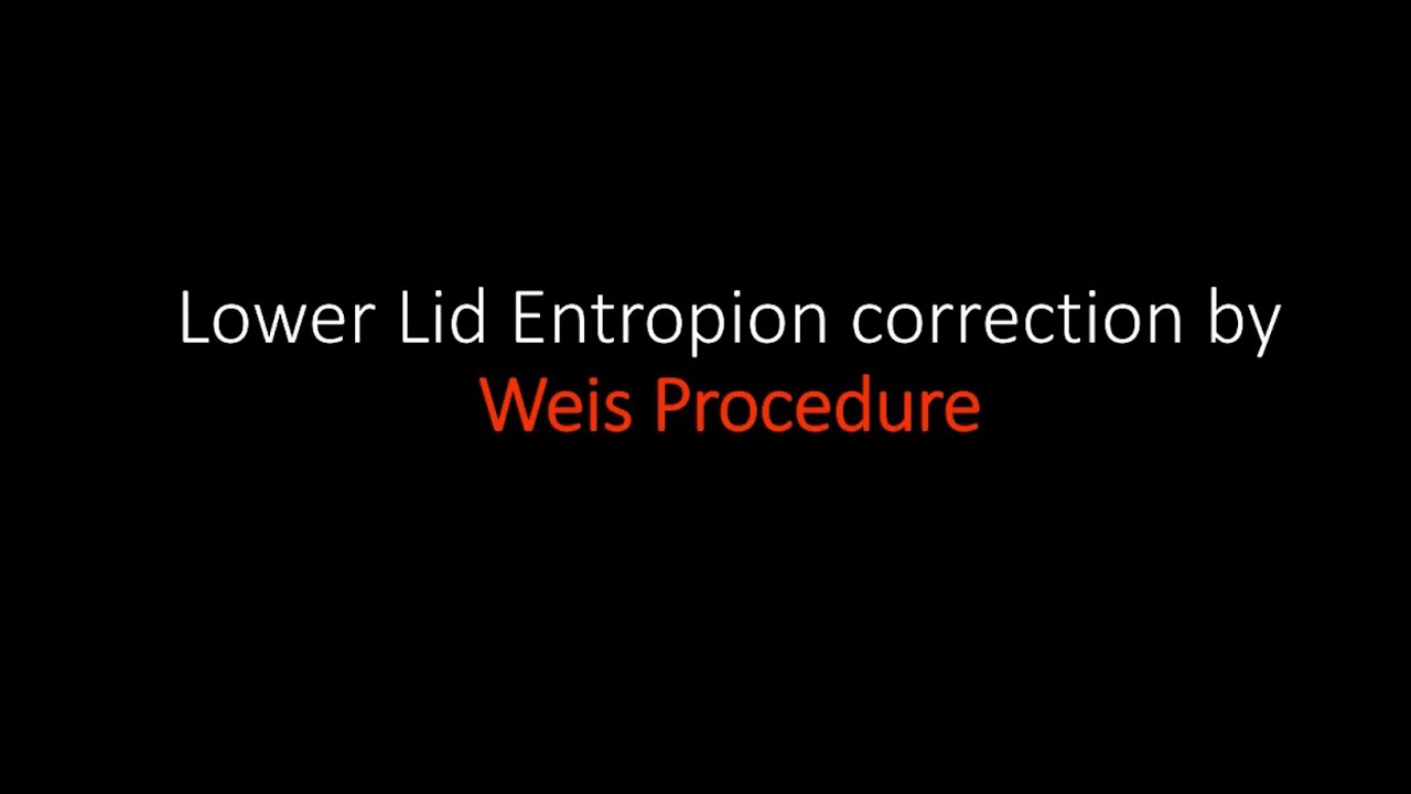Lower Lid Entropion correction by Weis procedure - YouTube