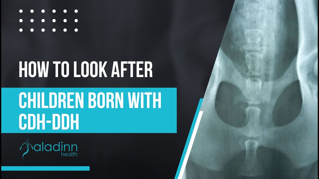 How To Look After Children Born With CDH-DDH - Dr. Kapil Gangwal - YouTube