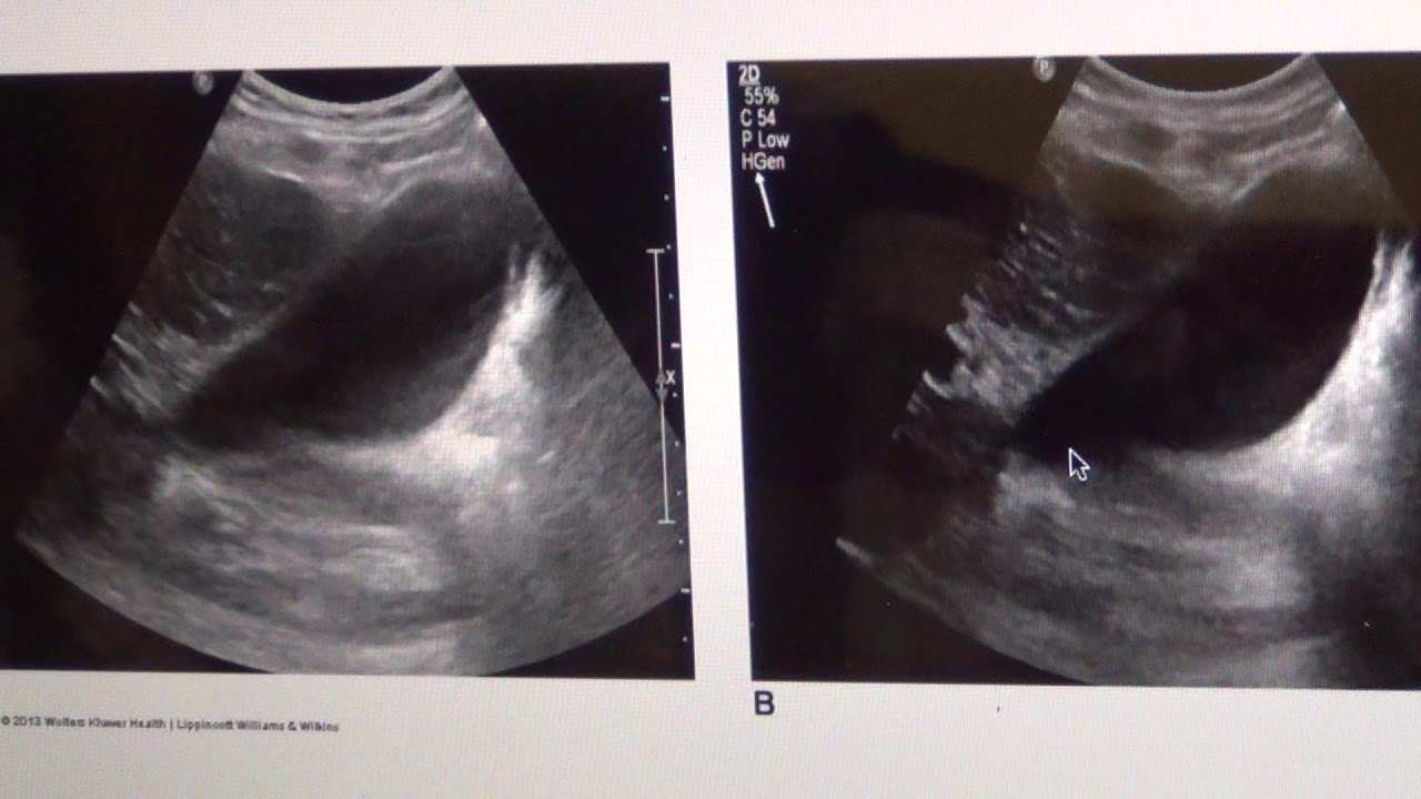 ULTRASONOGRAPHY FOR THE BEGINNERS: BILIARY SYSTEM NORMAL AND ABNORMAL ...