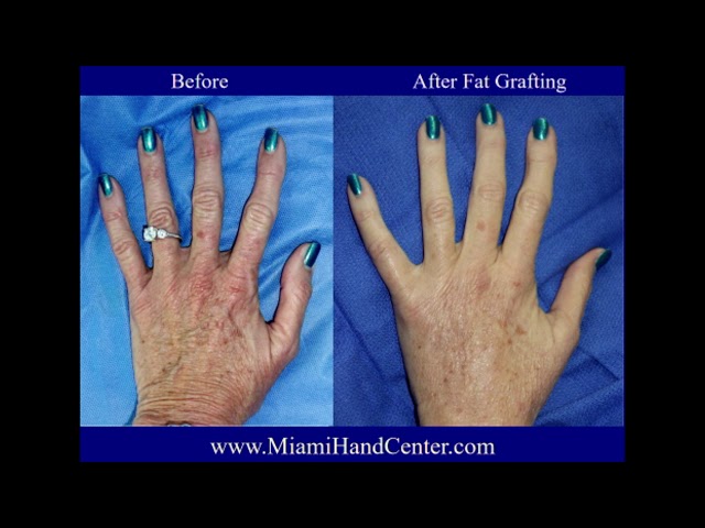 Cosmetic Surgery On Fingers Regenerative Tissue Engineering: Recent
