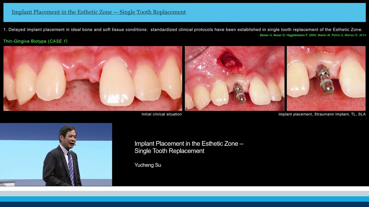 Implant Placement in the Esthetic Zone – Single Tooth Replacement ...