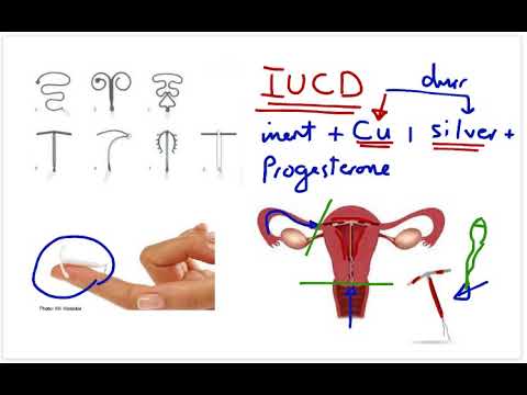 contraception 2 " IUCD and its complications " - YouTube