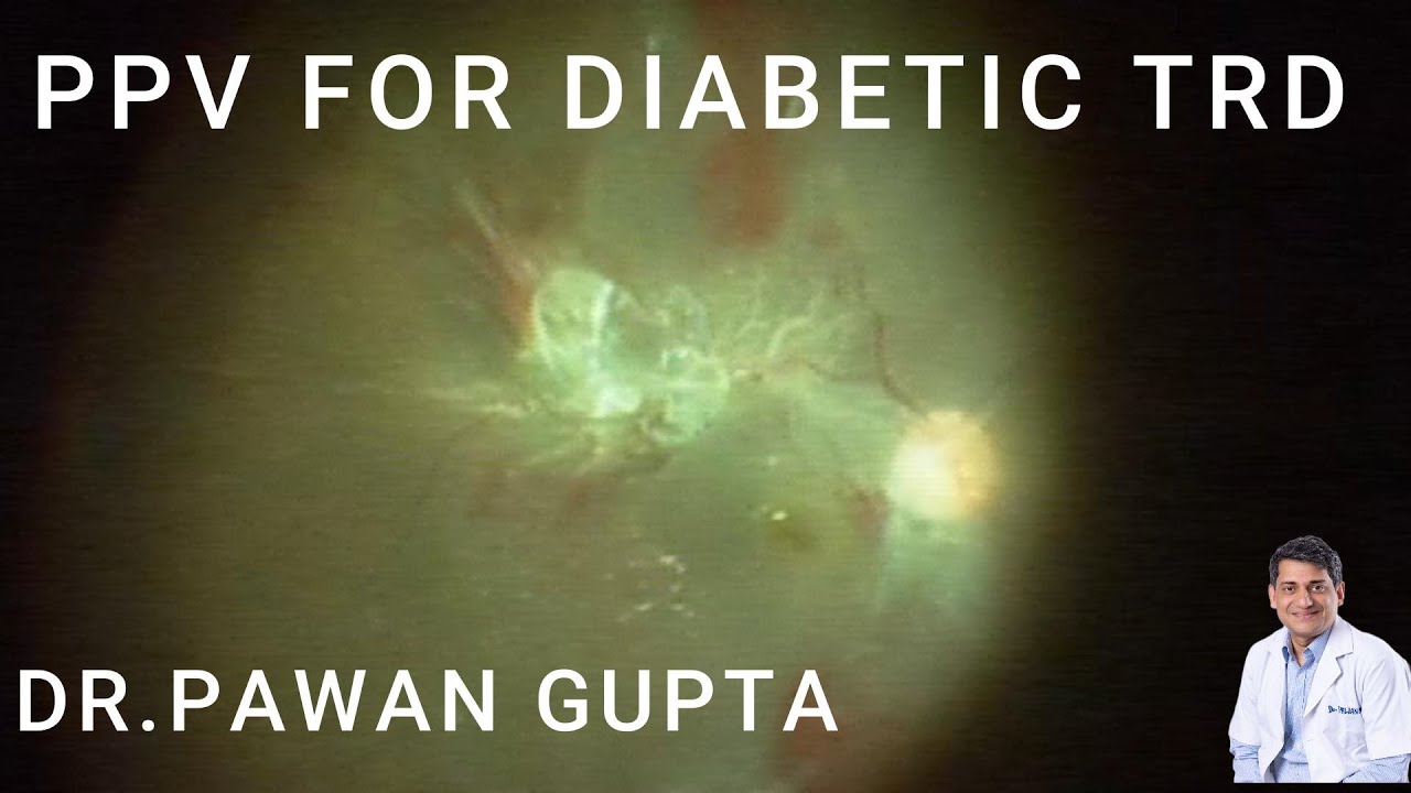 DIABETIC TRACTIONAL RETINAL DETACHMENT |PPV WITH GAS TAMPONADE| DR ...