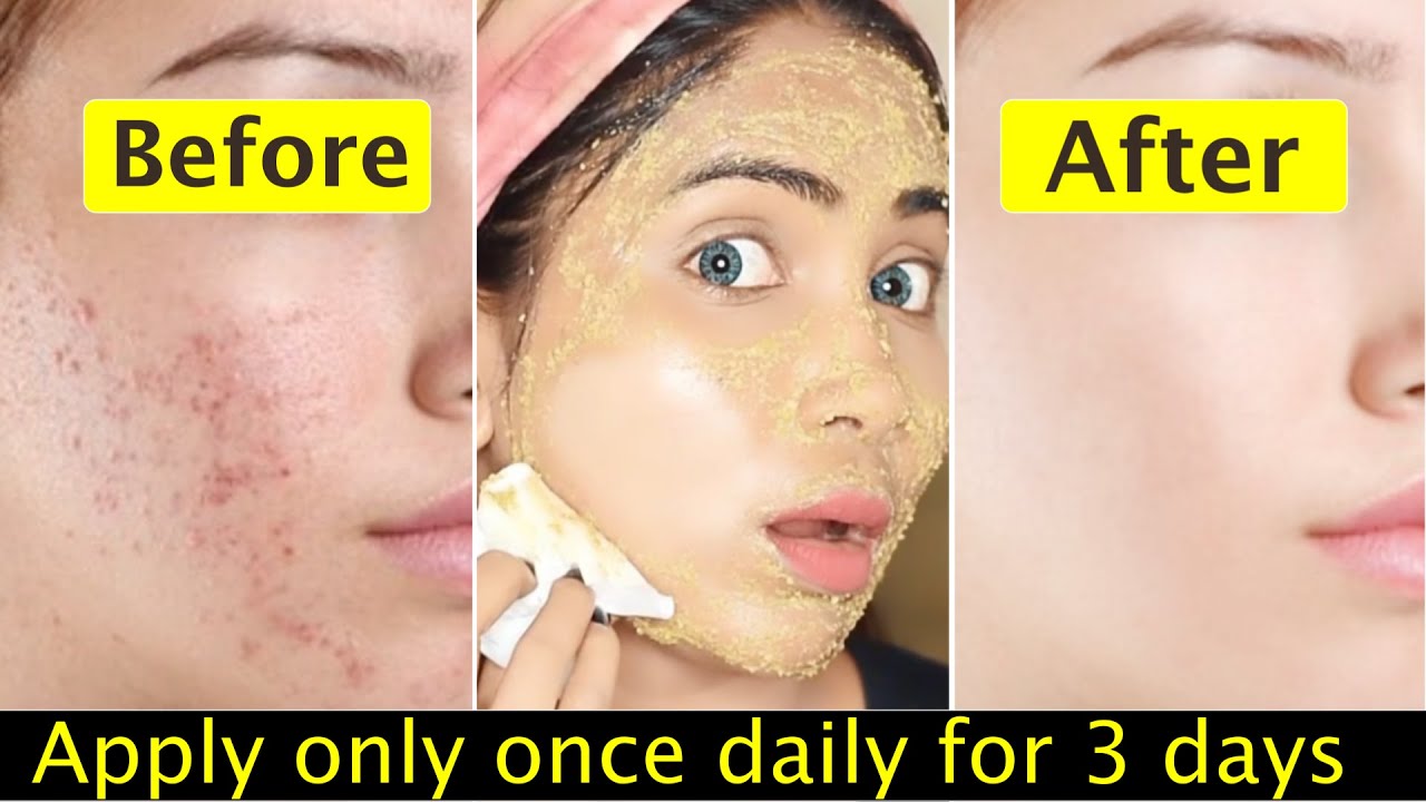 Teenager Skin Transformation Challenge-Pimples, whiteheads, acne marks ...