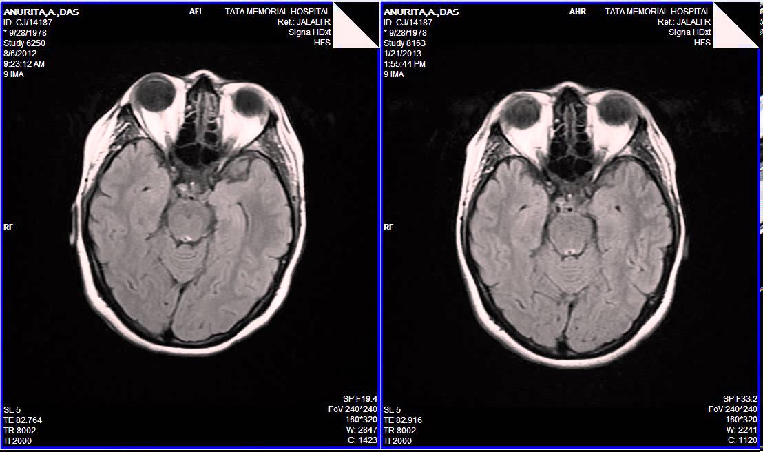 Ax T2 FLAIR - Left(02-Aug-2012) Right (21-Jan-2013) - YouTube