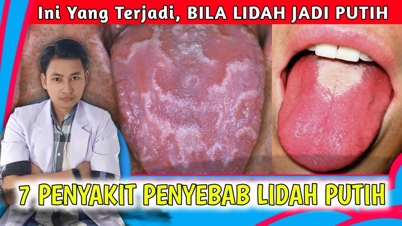 Mengapa Lidah Berwarna Putih? Begini Penyebab dan Cara mengatasinya ...