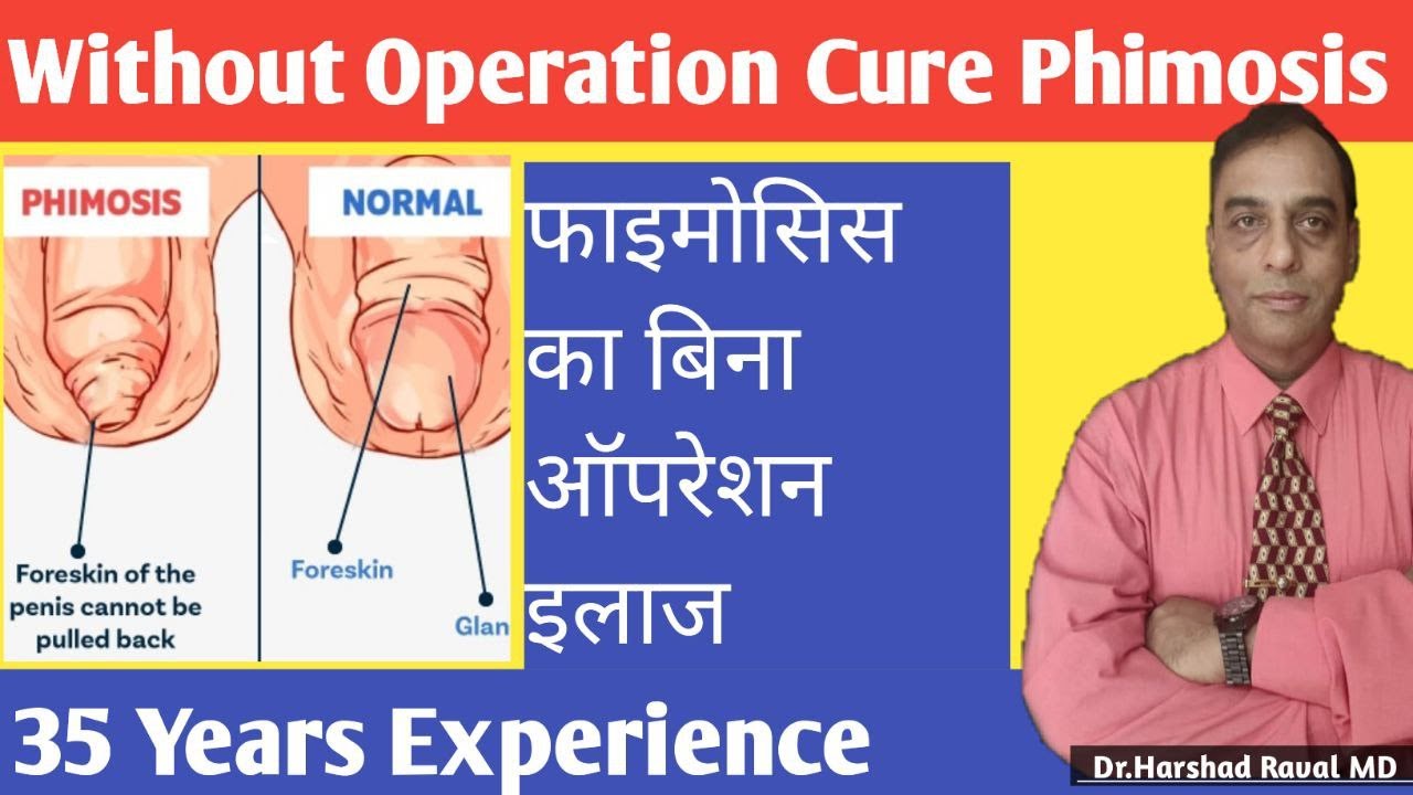 फाइमोसिस का बिना ऑपरेशन इलाज । Phimosis Cure Without Operation - YouTube