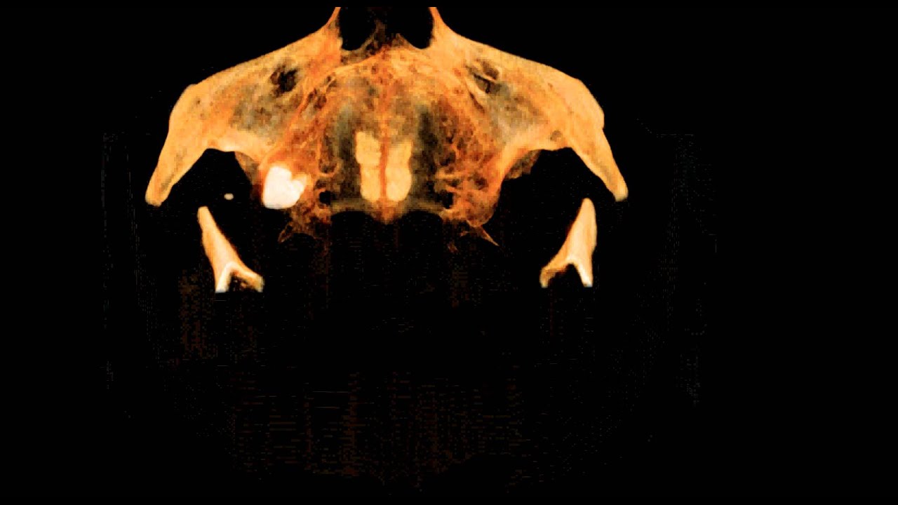 Radiología Maxilofacial Torus Maxilar - YouTube