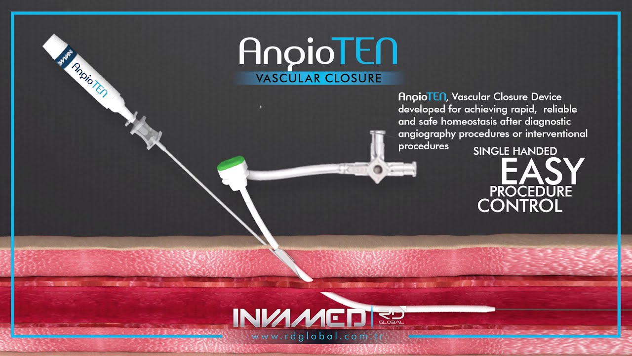 Vascular Closure Device ~ AngioTEN ~ - YouTube