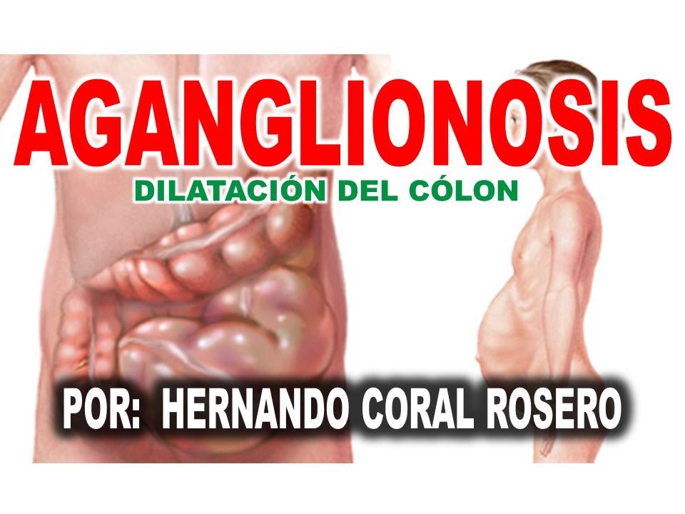AGANGLIONOSIS - DILATACIÓN DEL CÓLON - YouTube