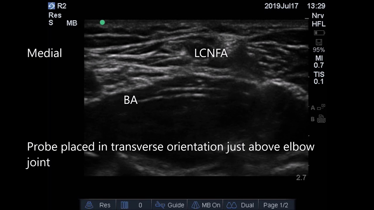 Ultrasound guided Arm nerve block - YouTube