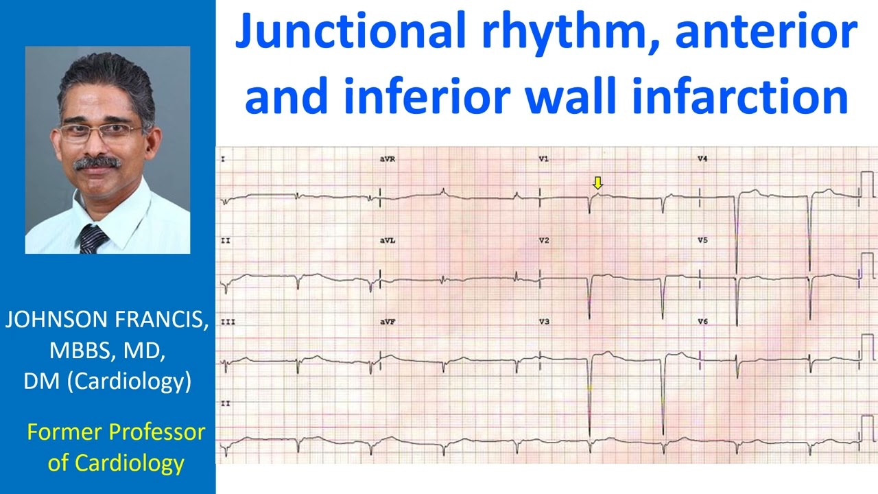 Slow Junctional Rhythm