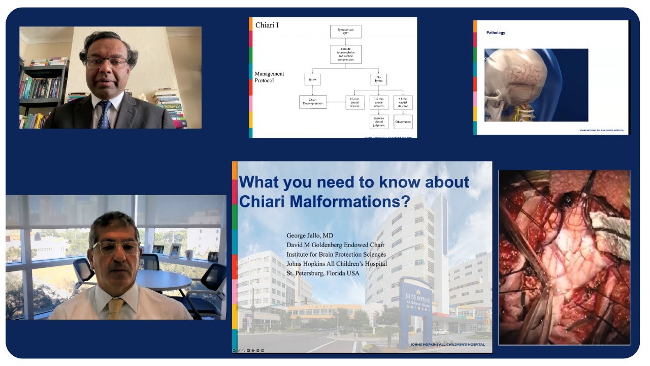 Chiari Malformation - Dr George Jallo - YouTube