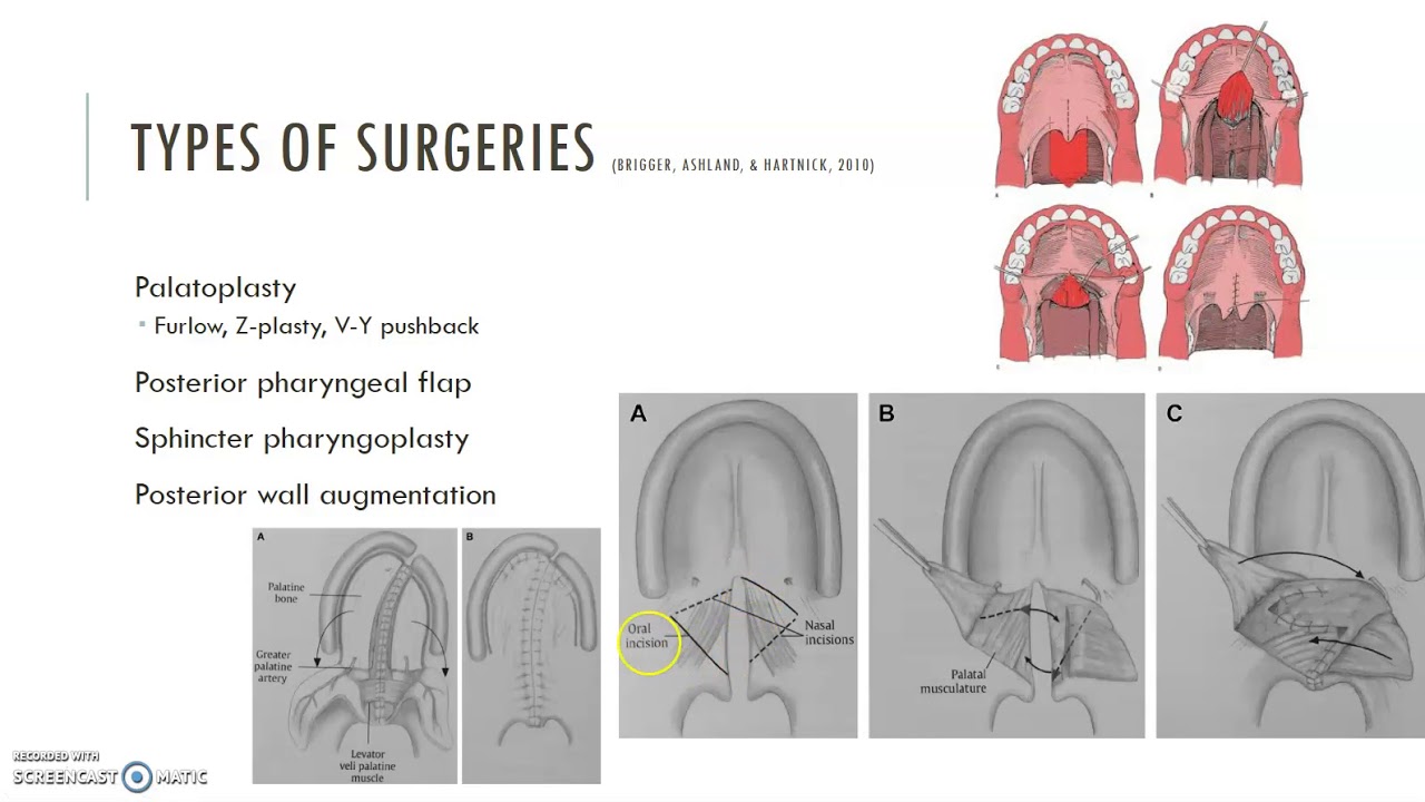 VPI Treatment - YouTube