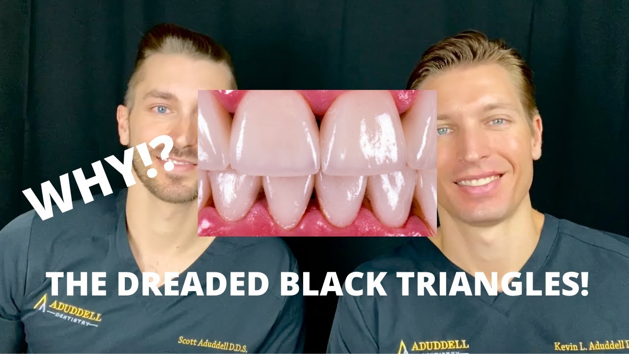BLACK TRIANGLES BETWEEN TEETH! WHY?? - YouTube