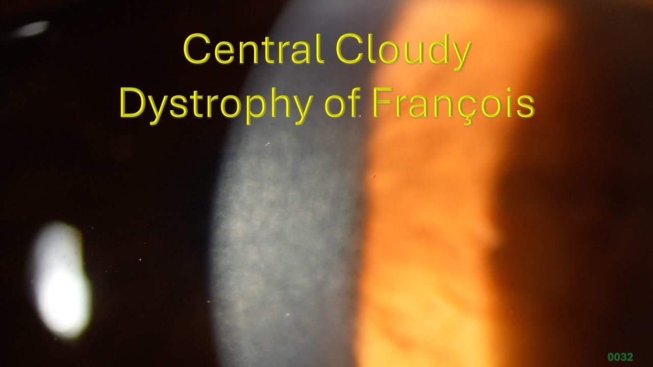 0032: Central Cloudy Dystrophy of François - YouTube