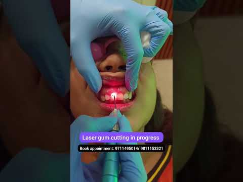 Is Laser Gum Contouring Permanent