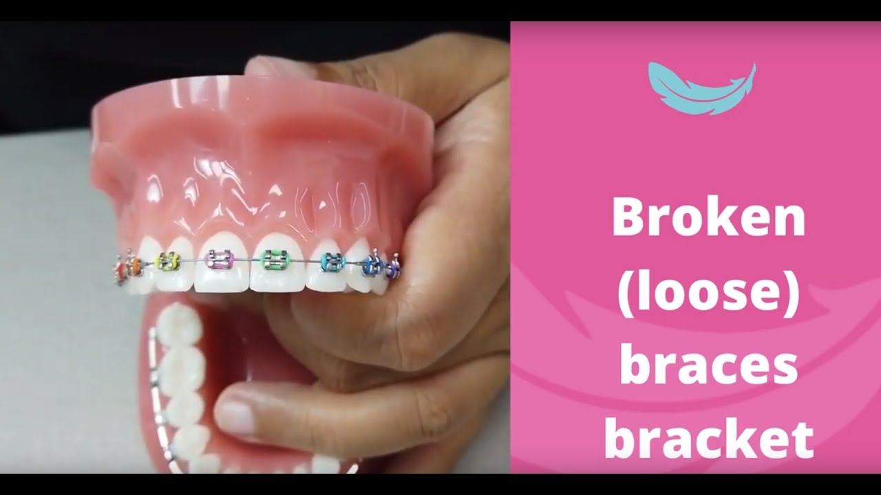 How to fix a problem with your braces when you're at home - YouTube