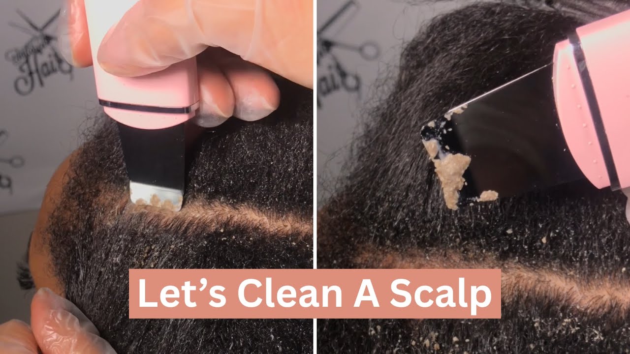 Flaky Scalp Removal Spray Recipe | Dandruff Scratching Spatula | Dry ...