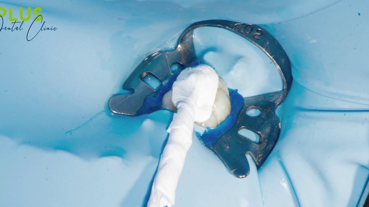 Occlusal stamp technique - YouTube