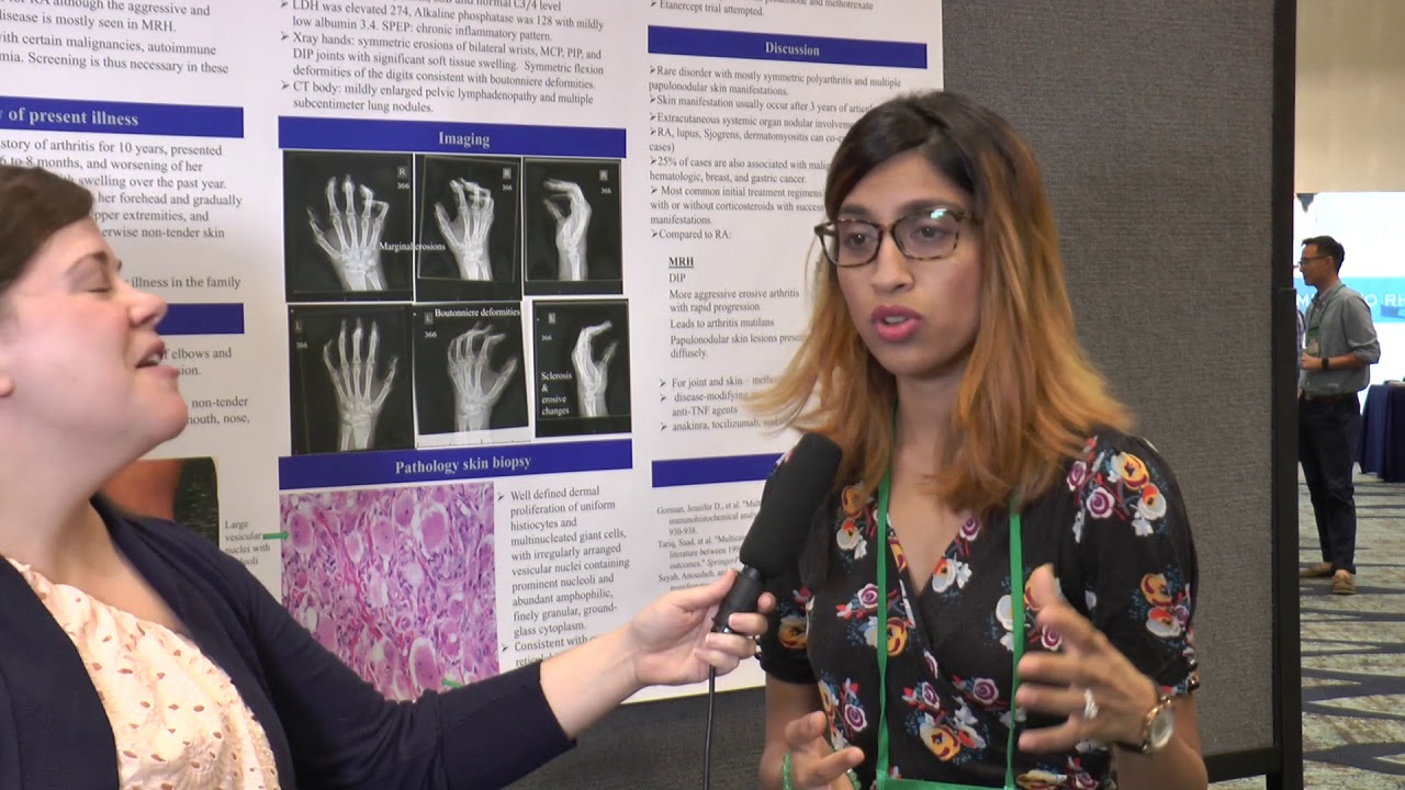 Dr. Sheetal Patel at RWCS 2018, Poster Presentation - YouTube