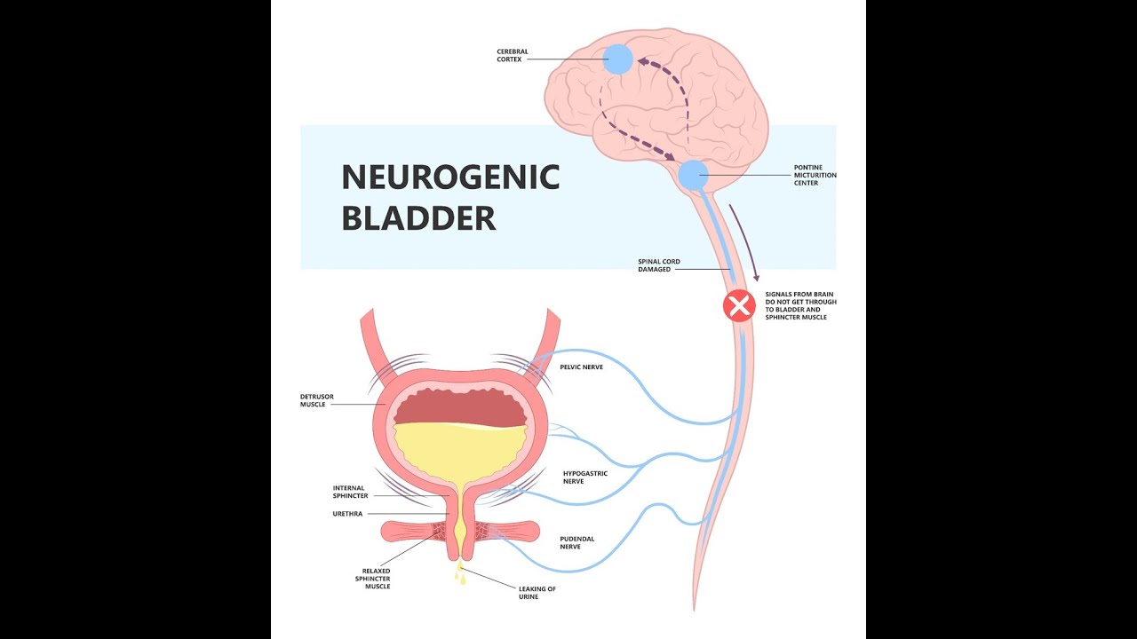 Neurogenic Bladder ; Definition, Causes, Symptoms, Diagnosis, Treatment ...