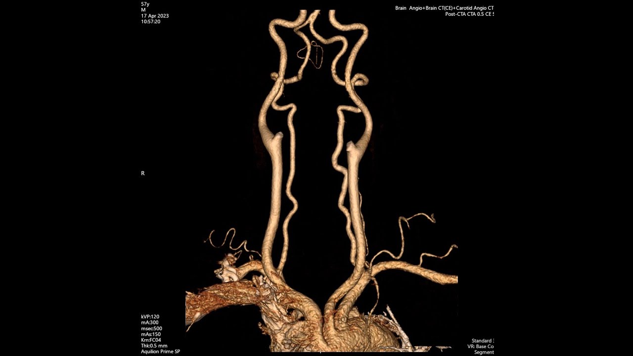 normal brain angio 3D - YouTube