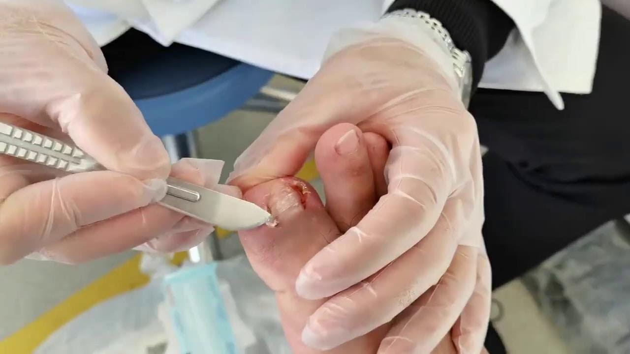 How to treat paronychia correctly - YouTube