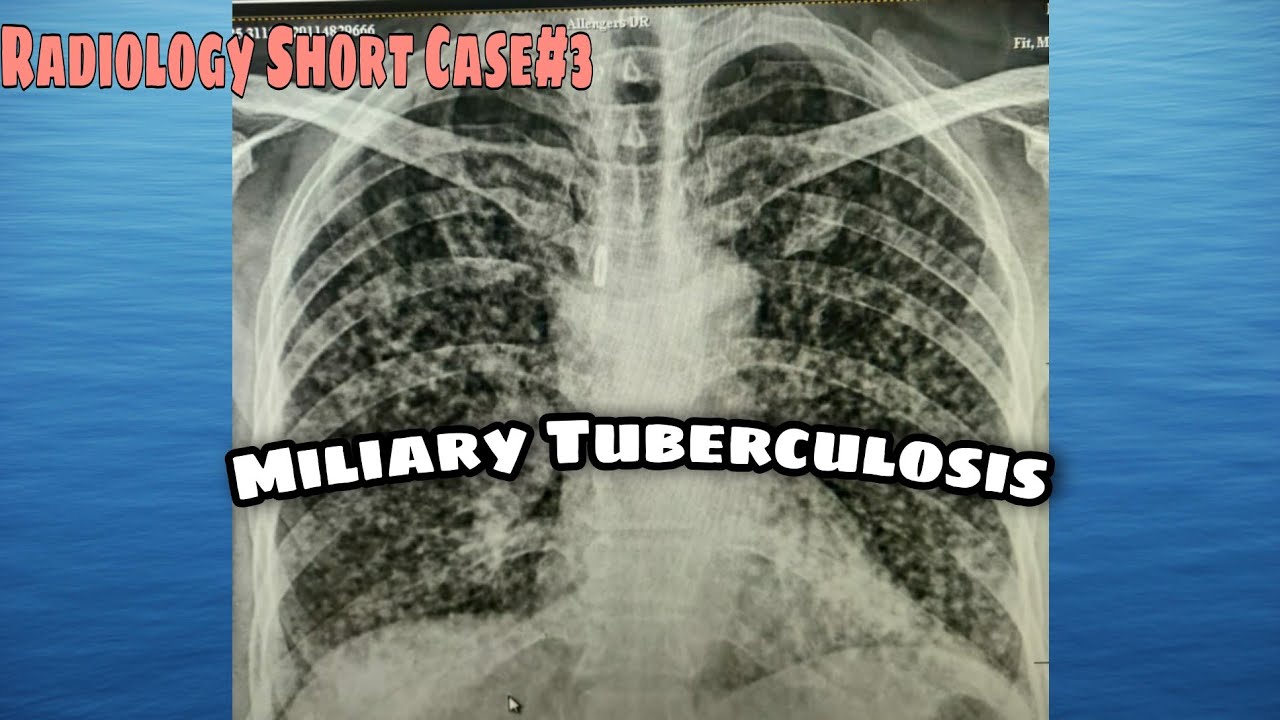 Miliary Tuberculosis-- Radiology short case - YouTube
