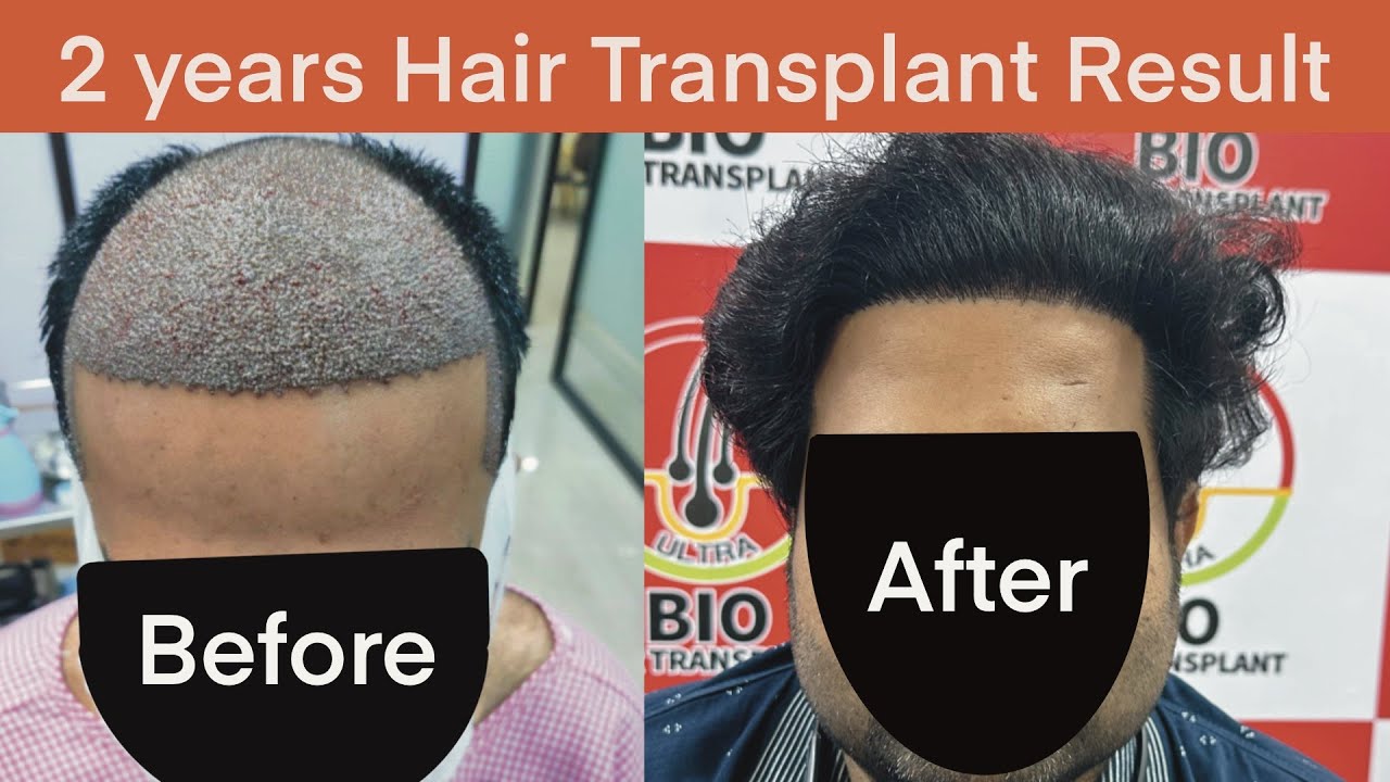 2 years of hair transplant result | ultra bio hair transplant results ...