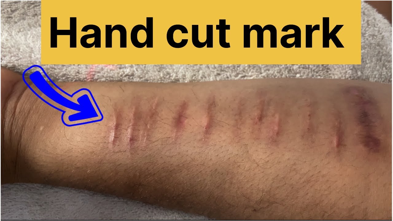 Hand cut mark removal.skin theek Kare 👍 - YouTube