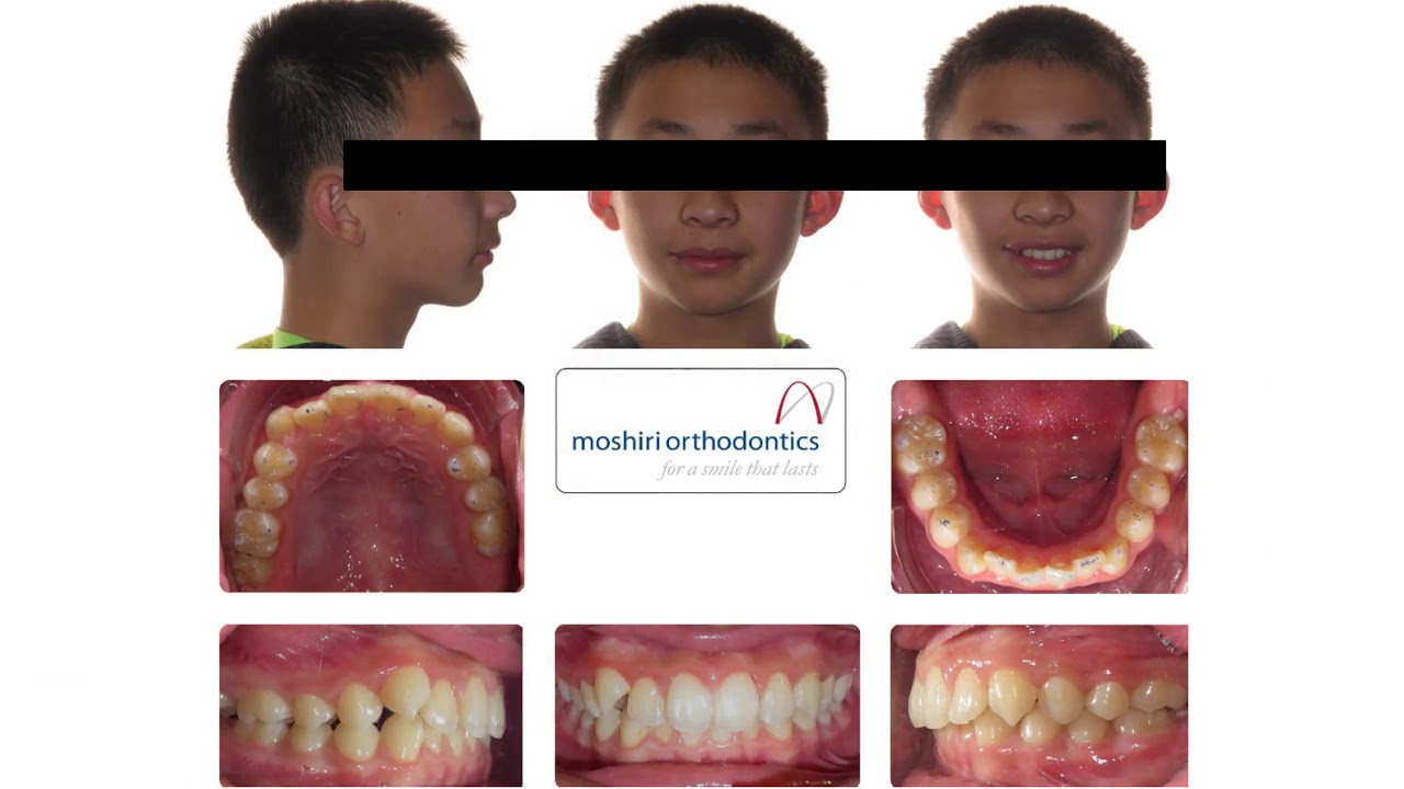 Quick Tip - Class II Correction with Clear Aligners - YouTube