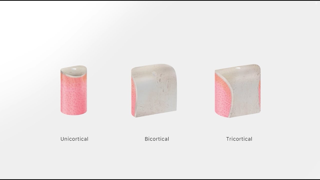 Bone harvesting by Autograft Harvesting System - YouTube