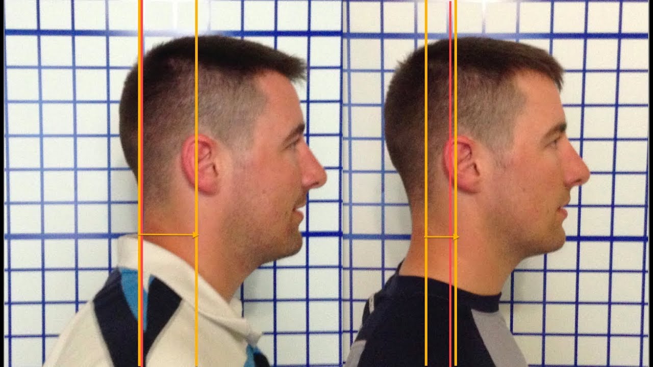 NeuroCranial Restructuring® for Reversing Concussions! A former ...