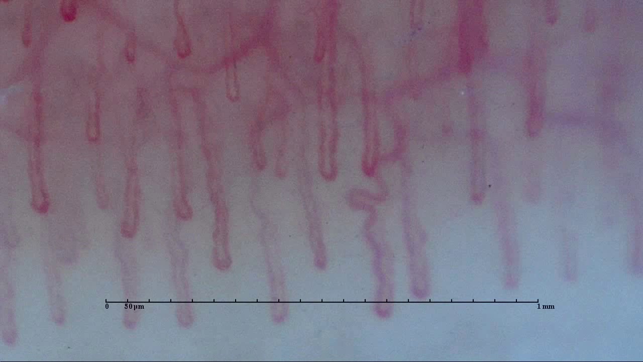 Nailfold Capillary image captured by Smart G-Scope(Woman) - YouTube