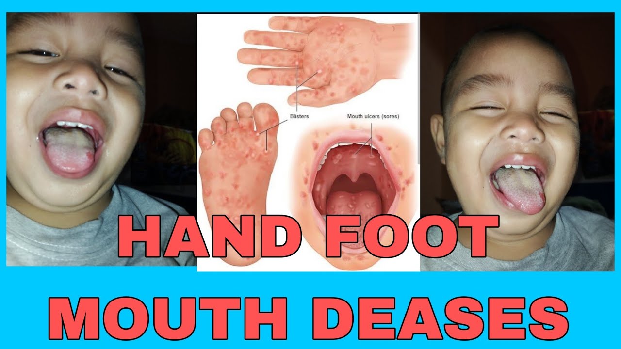 Hand Foot Mouth Deases Symtoms Virus Dinapuan Si Darius - YouTube