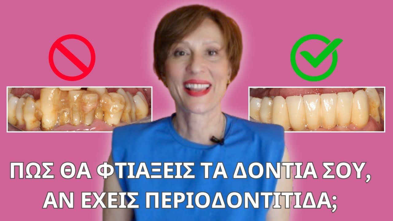 ΠΡΟΣΘΕΤΙΚΗ δοντιών, για ασθενείς με ΠΕΡΙΟΔΟΝΤΙΤΙΔΑ - YouTube