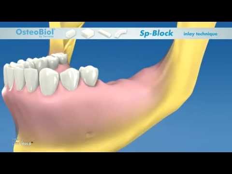 Sp-Block Osteobiol - YouTube