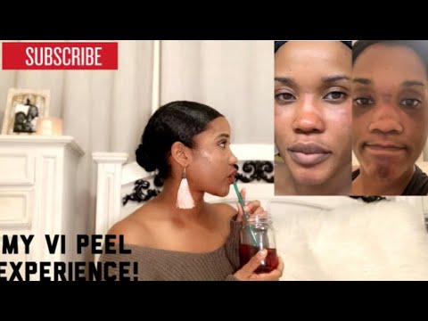 My VI PEEL Experience—FULL CHEMICAL PEEL PROCESS; Vi Peel - YouTube