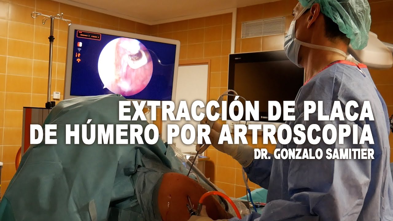 EXTRACCIÓN DE PLACA PHILOS DE HÚMERO PROXIMAL POR ARTROSCOPIA ...
