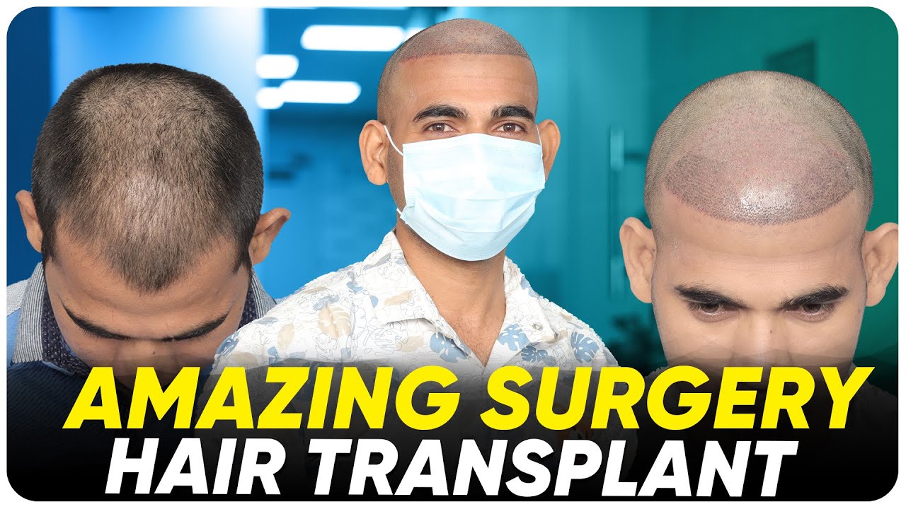Hair Transplant in Lucknow | Best Results & Cost of Hair Transplant in ...