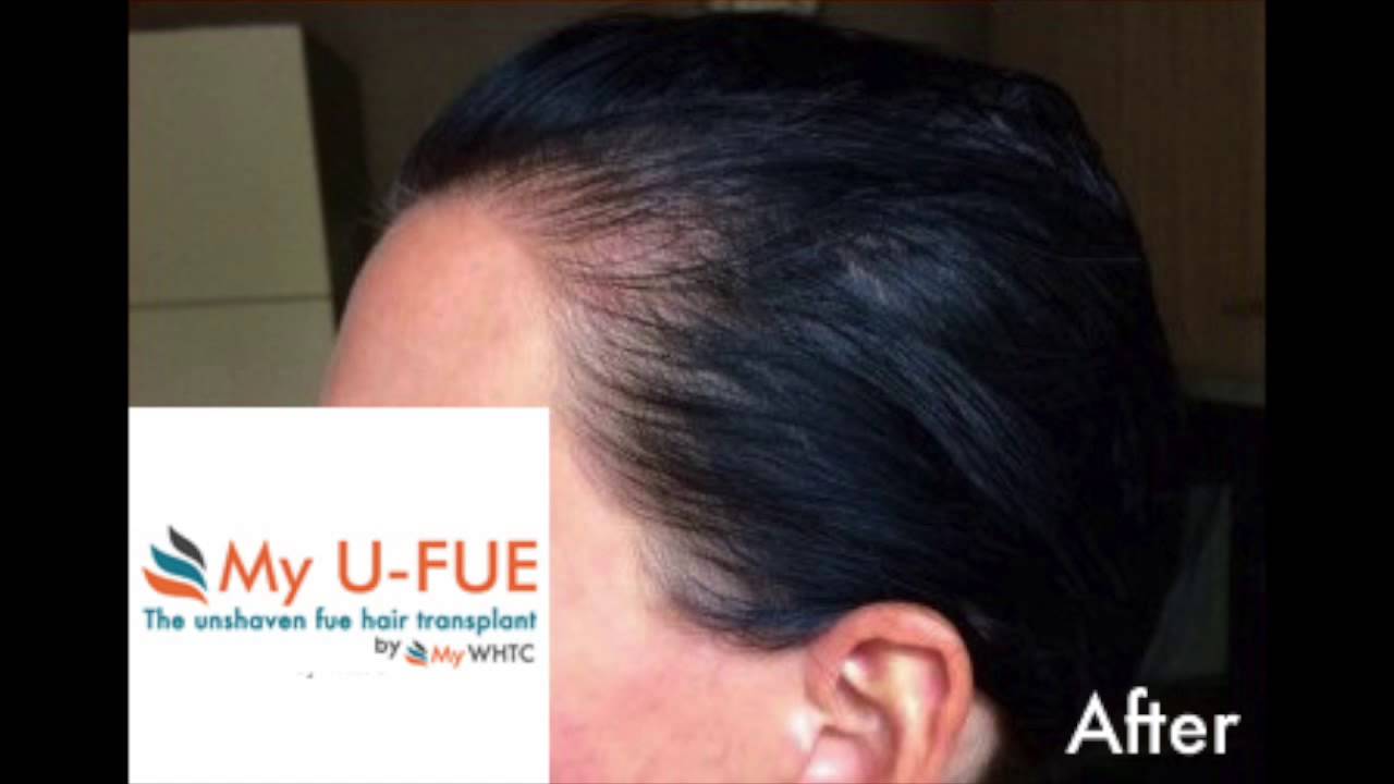 Dr. Patrick Mwamba My WHTC Belgium FUE Hair Transplant Women 1010 ...