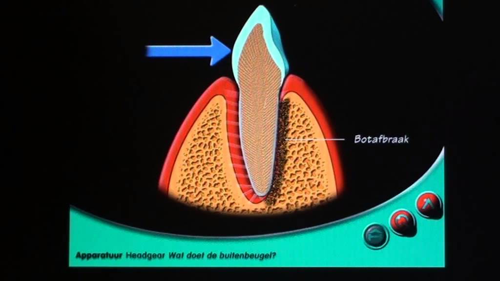 Headgear: wat doet de buitenbeugel? - YouTube