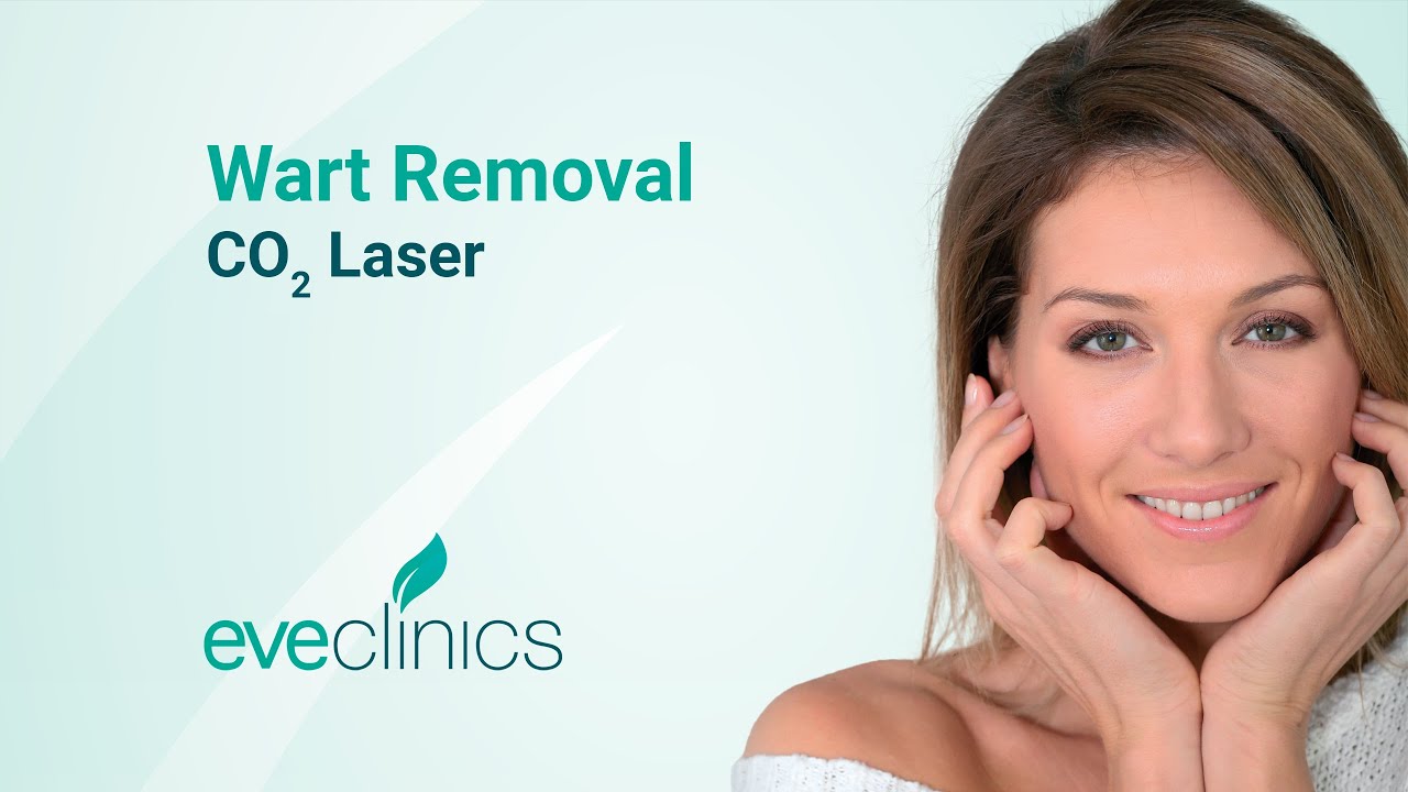 How To Get Rid Of A Wart: The CO2 Laser Method - YouTube
