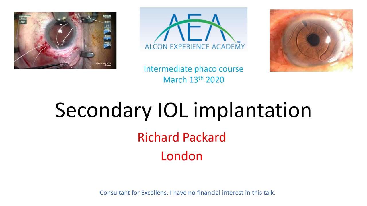 Secondary IOL implantation - YouTube