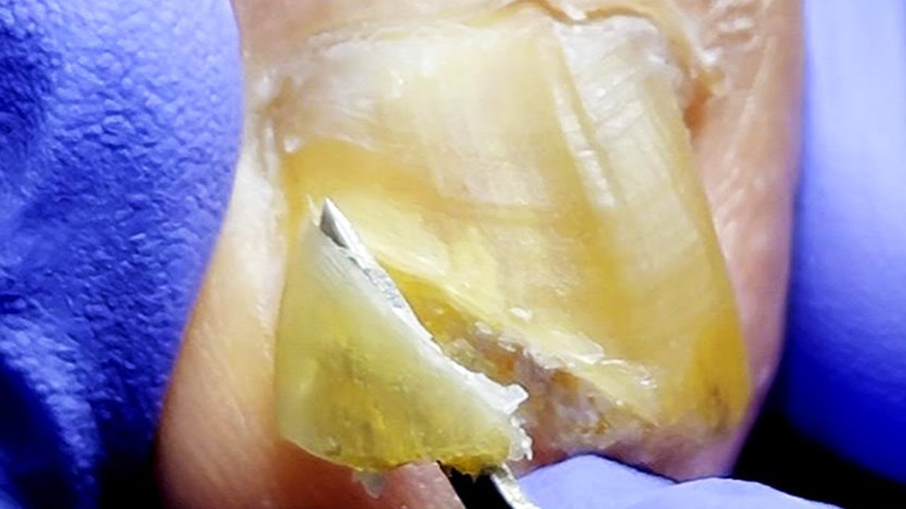 Hard Toenails With Large Patches Of Fungal Infection【Xue Yidao Pedicure ...