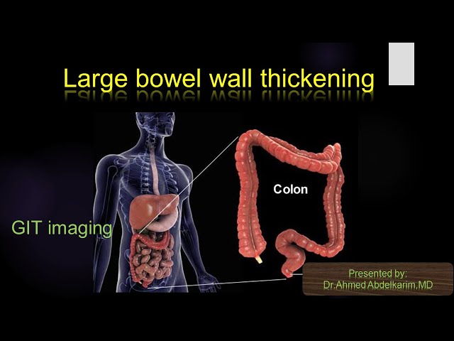 Thickening Of Ascending Colon Colon Wall Thickening: Appearance,